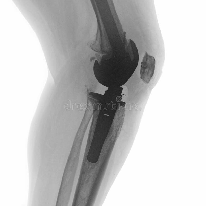 Prosthetic Leg and Knee Mechanism Stock Image - Image of revival ...