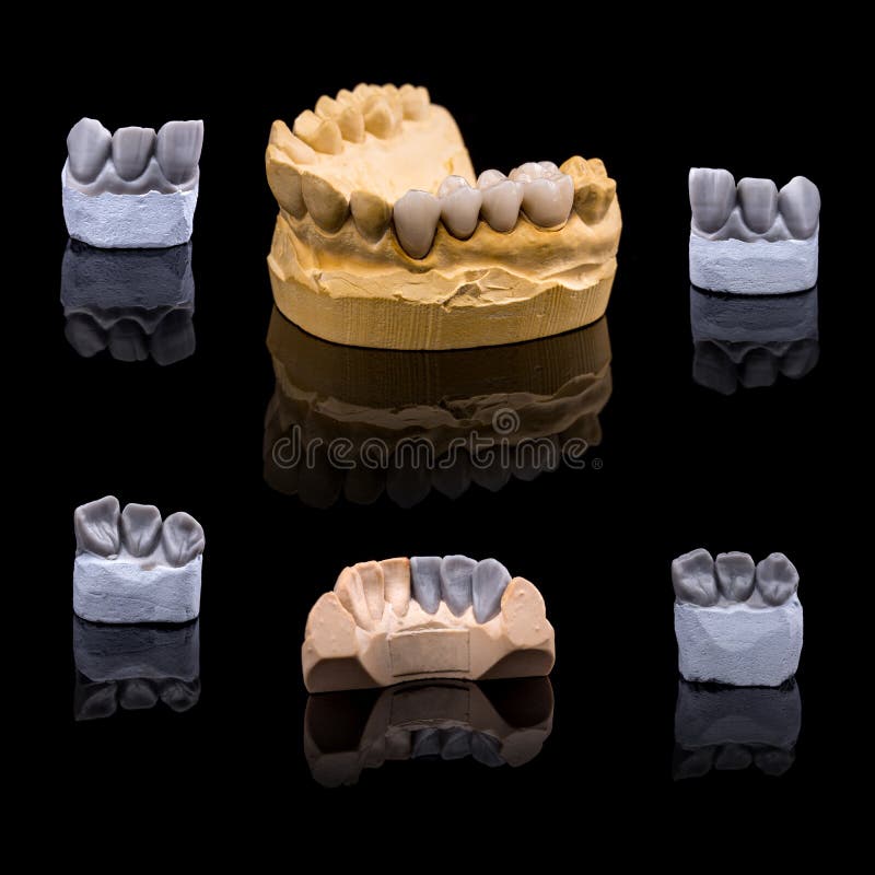 Artificial tooth stock image. Image of black, prothesis - 74101249