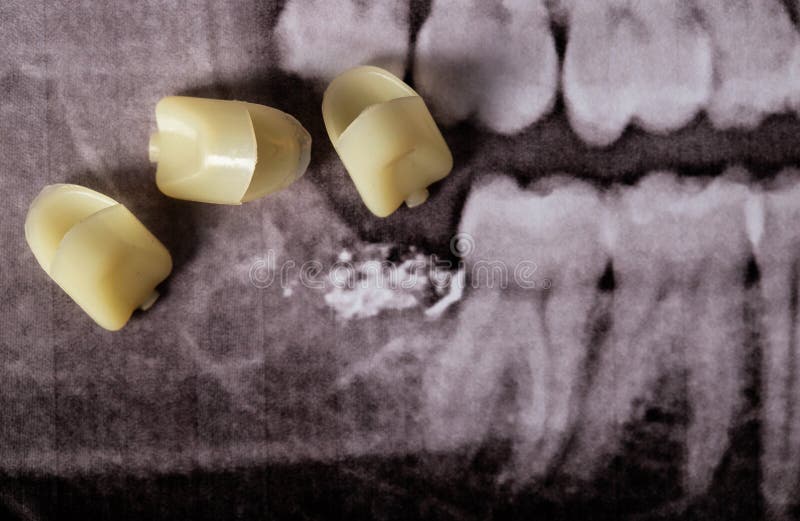 Artificial Wisdom Teeth Against the Background of an X-ray Image with ...