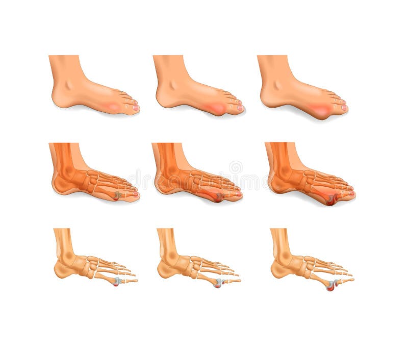 Deformare Artrosi Del Piede Illustrazione Vettoriale - Illustrazione di ...