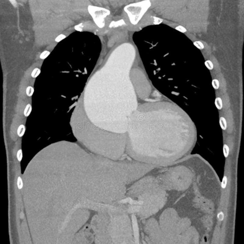 Aortic Aneurysm Ct Scan