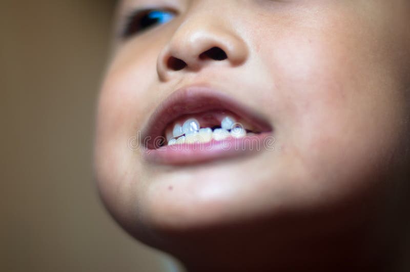 Asian Boy with Broken Teeth Stock Image - Image of broken, adorable ...