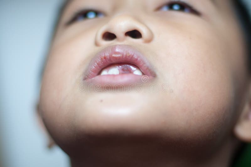 Asian Boy with Broken Teeth Stock Photo - Image of cheerful, young ...