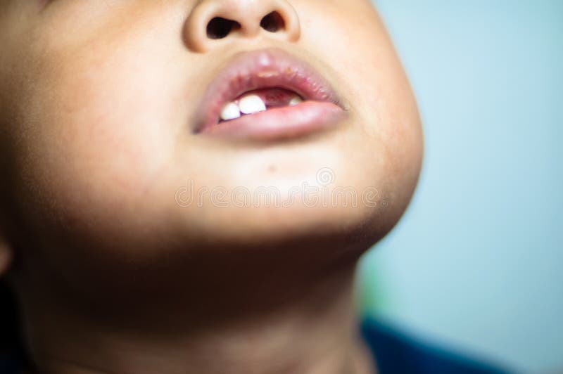 Asian Boy with Broken Teeth Stock Photo - Image of young, face: 49620926