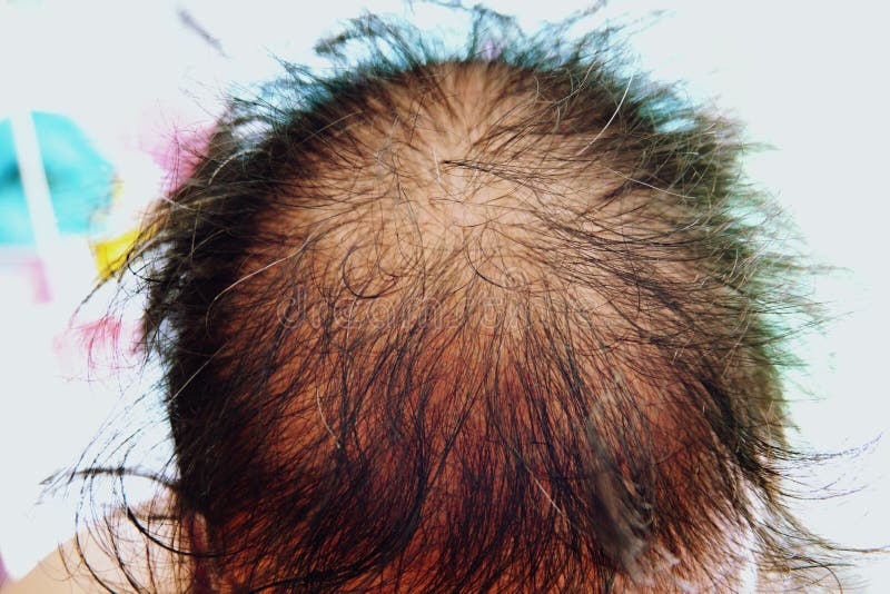 Asian Female Head with Hair Loss Problem Stock Image - Image of adult ...