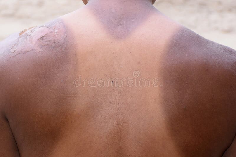 Asian Man Back with Red Skin Sunburn after Work in the Fields Stock ...