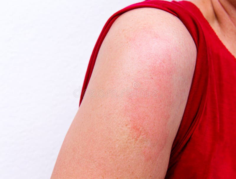 221 Bacteria Tetanus Stock Photos - Free & Royalty-Free Stock Photos ...