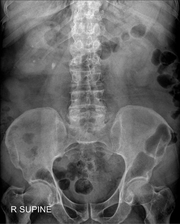 Assessing Radiopaque Renal Stones through KUB X-ray Stock Photo - Image ...