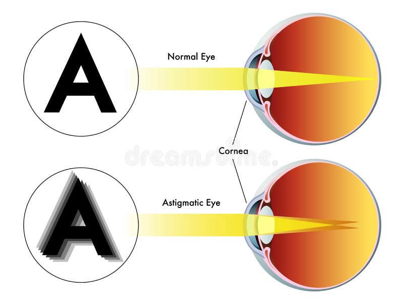 Vision Defects - Myopia, Hyperopia and Astigmatism Stock Vector ...