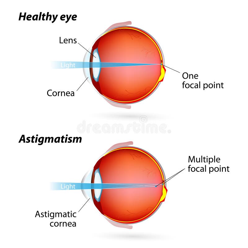 Astigmatism stock vector. Illustration of cylindrical - 55741003
