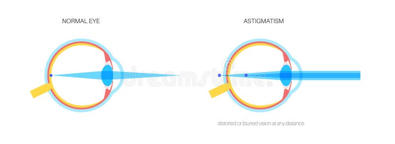 Astigmatism eye disease stock vector. Illustration of anatomy - 302325704