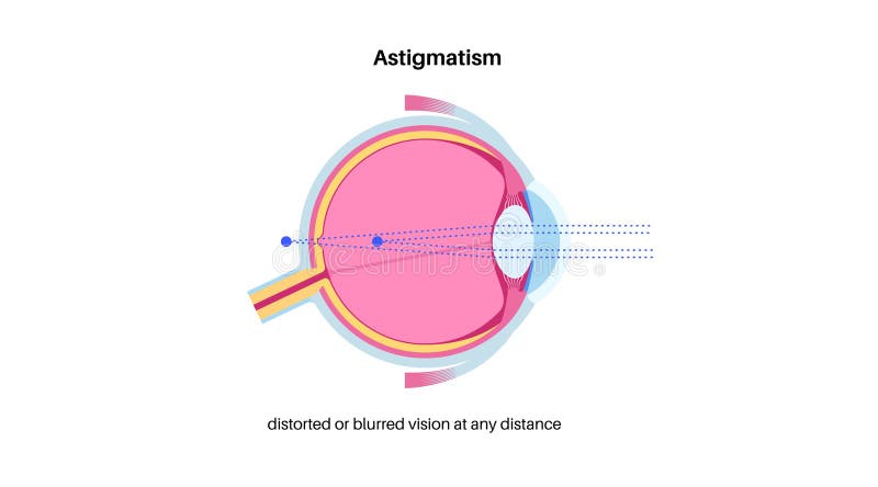 Astigmatism eye disease stock vector. Illustration of surface - 302450088