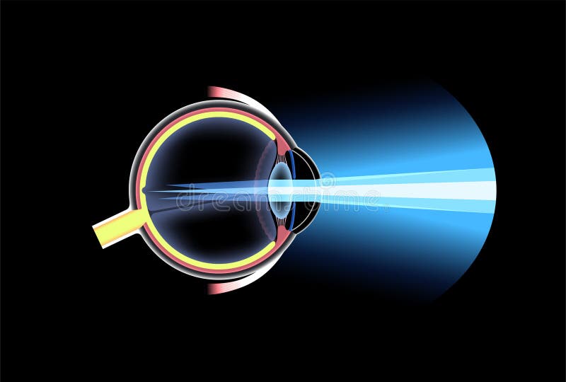 Astigmatism eye disease stock vector. Illustration of organ - 353241577