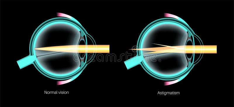 Astigmatism eye disease stock illustration. Illustration of tissue ...