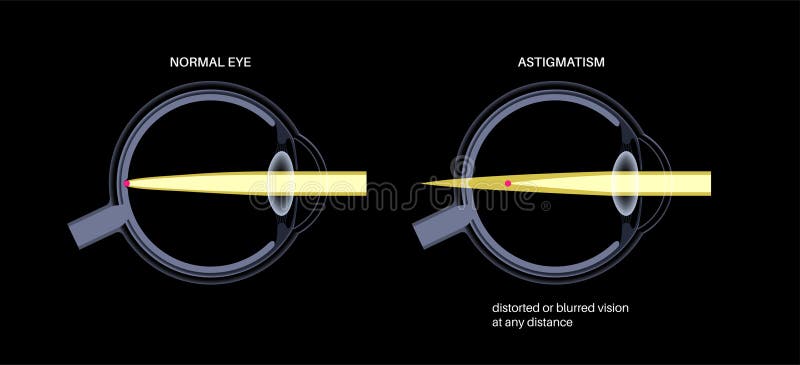 Astigmatism eye disease stock illustration. Illustration of body ...