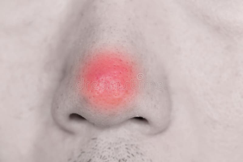 Bouton rouge sur le nez image stock. Image du blackhead - 46475599