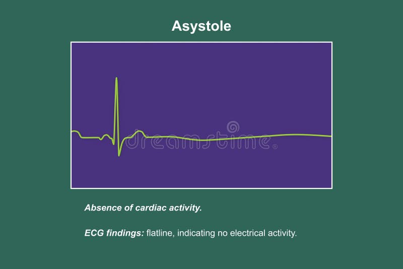 Asystole Stock Illustrations – 65 Asystole Stock Illustrations, Vectors ...
