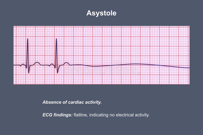 ECG in Asystole, 3D Illustration Stock Illustration - Illustration of ...