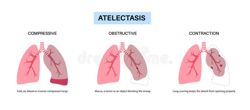 Atelectasis medical poster stock vector. Illustration of alveolar ...