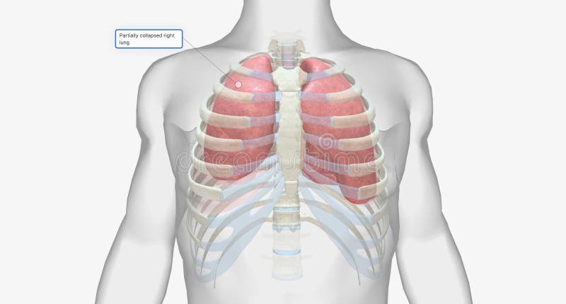 Atelectasis (lung Collapse) is a Pulmonary Condition that Occurs when ...