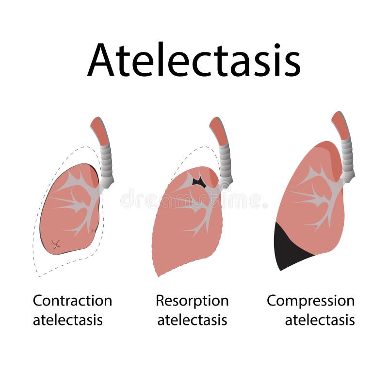 Atelectasis stock vector. Illustration of pulmonary, breath - 57447781
