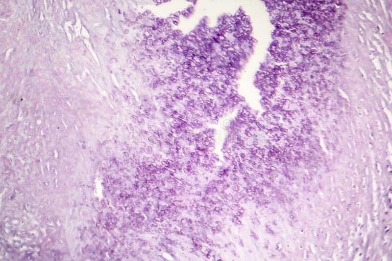 Ateroesclerosis Aórtica, Micrográfo Ligero Imagen de archivo - Imagen ...