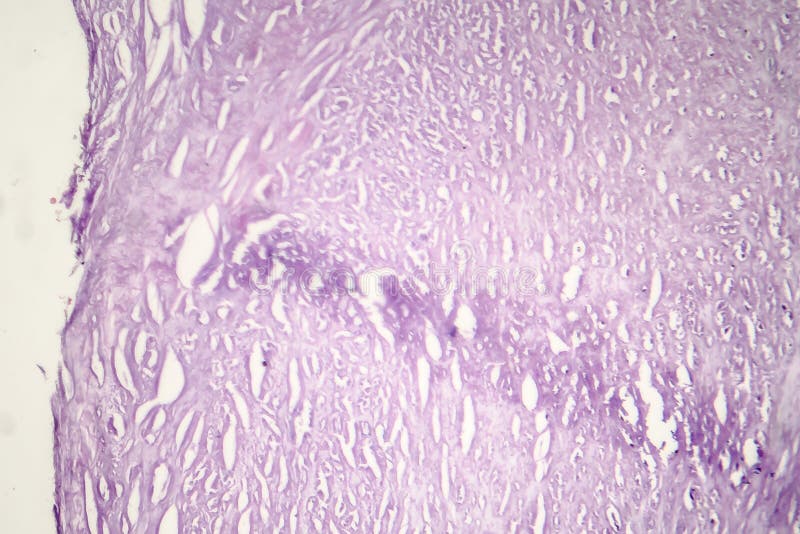 Aterosclerosi Aortica, Micrografo Leggero Immagine Stock - Immagine di ...
