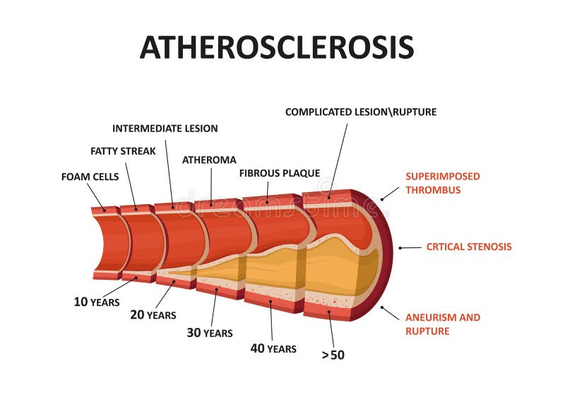 Atherosclerose & Arteriosclerose Vector Illustratie - Illustration of ...