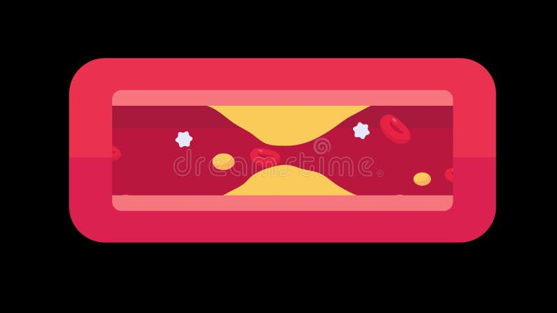 Atherosclerosis with High Cholesterol Causes High Blood Fat and Clogs ...