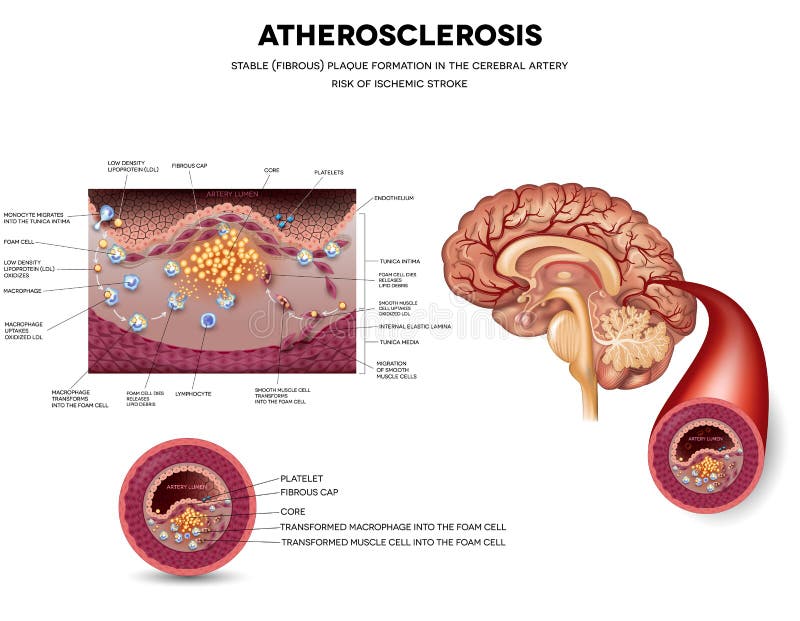 Atherosclerosis. Stable Plaque Formation Stock Vector - Illustration of ...