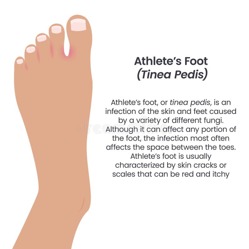 Athlete S Foot Tinea Pedis Vector Illustration Vector Infographic Stock ...