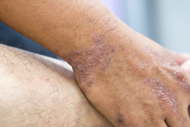 Atopic Dermatitis AD, Also Known As Atopic Eczema, is a Type of ...