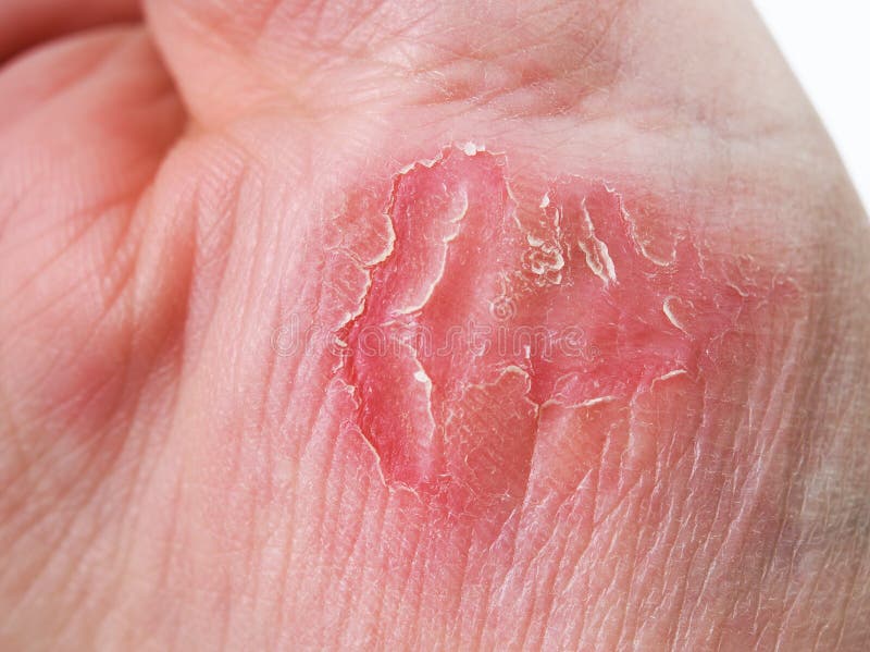 Atopic Dermatitis Ad Also Known As Atopic Eczema Is A Type Of Skin