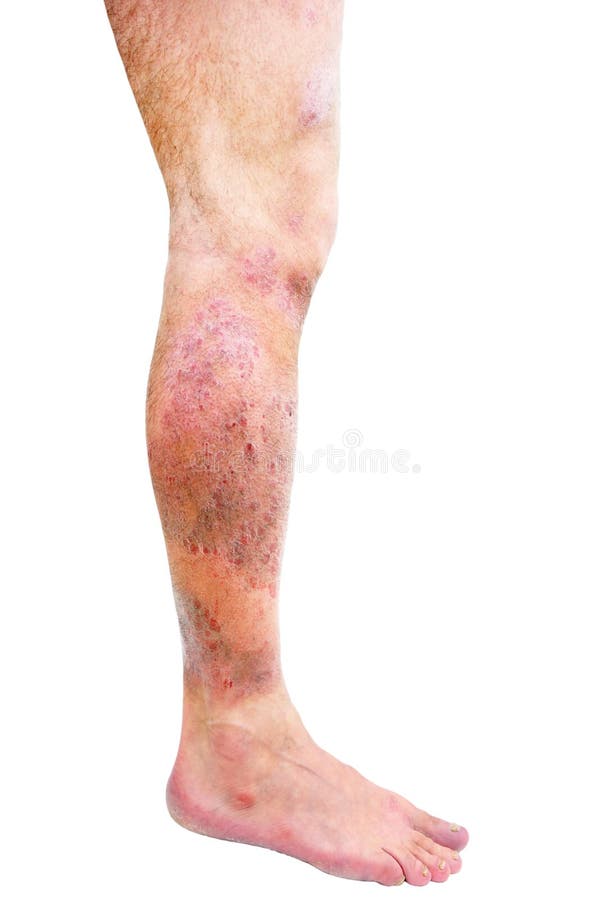 Atopic Dermatitis AD, Also Known As Atopic Eczema, is a Type of Skin ...