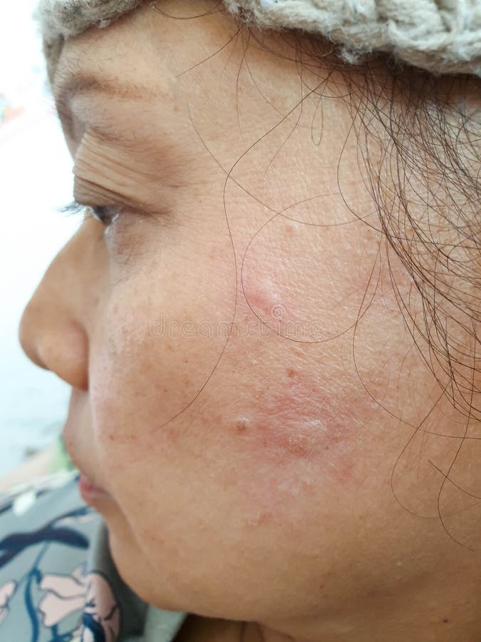 Atopic Dermatitis or Eczema Stock Photo - Image of cosmetology, dilates ...