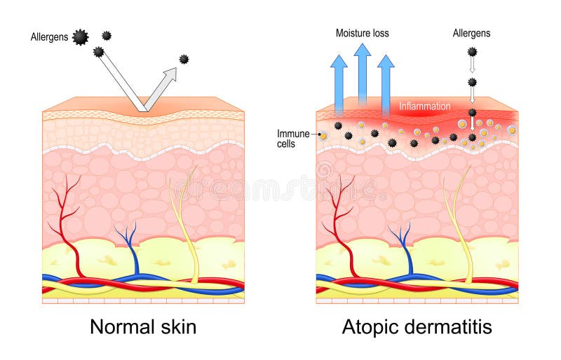 Atopic Dermatitis Histamine Stock Illustrations – 10 Atopic Dermatitis ...
