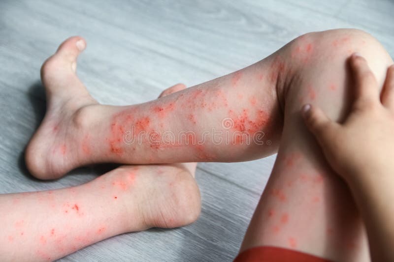 Atopic Dermatitis on the Legs of a Child Stock Photo - Image of healing ...