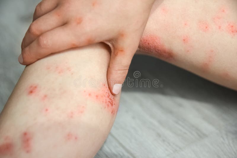 Atopic Dermatitis on the Legs of a Child Stock Photo - Image of ...