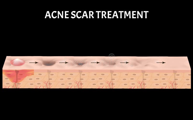 Atrophic Scars. Acne Scar. the Anatomical Structure of the Skin with ...