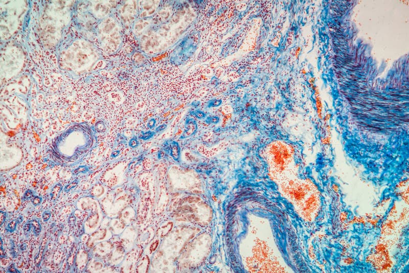 Atrophy kidney tissue stock photo. Image of corpuscles - 196728204