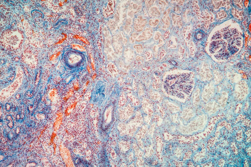 Atrophy kidney tissue stock image. Image of kidneys - 196728187