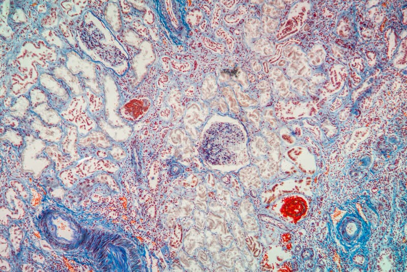 Atrophy kidney tissue stock image. Image of kidneys - 196728187