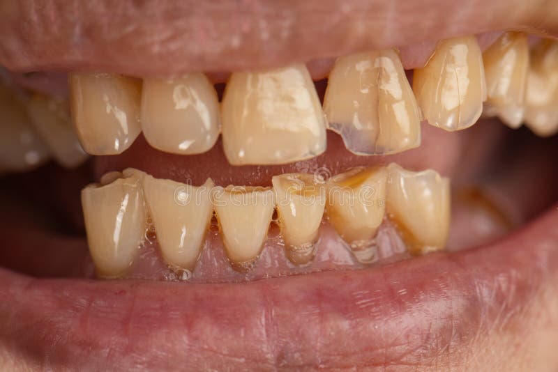 Attrition Tooth Due To Interaction with Other Teeth in Elderly Woman ...