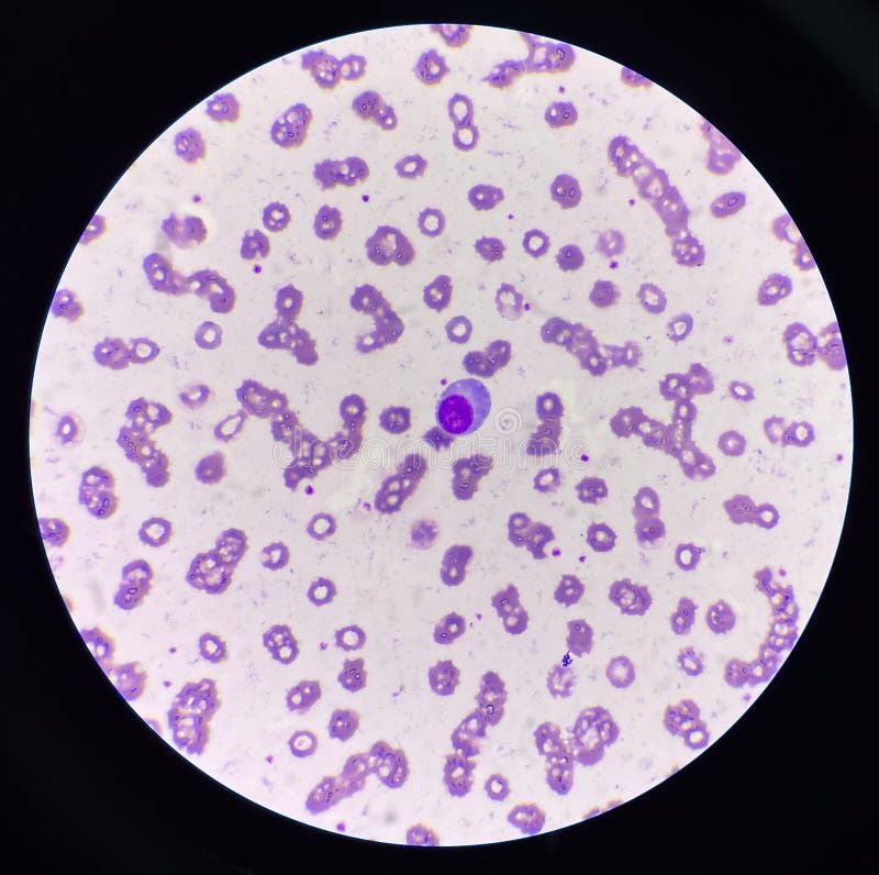 Atypical Lympho Cyte in Red Blood Cell Background Stock Image - Image ...