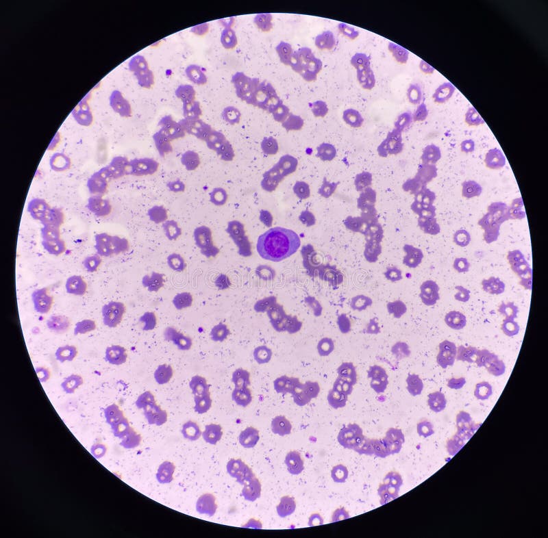 Atypical Lympho Cyte in Red Blood Cell Background Stock Photo - Image ...