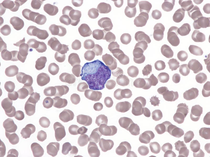 Atypical Lymphocyte in Peripheral Blood (Natalizumab). Stock Photo ...