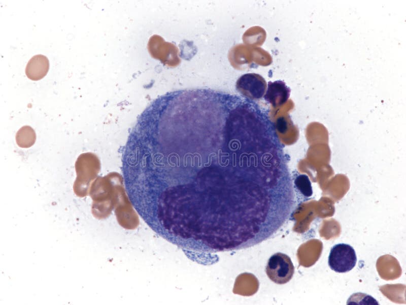 Atypical Megakaryocyte in a Case of Myelodysplastic Syndrome. Stock ...