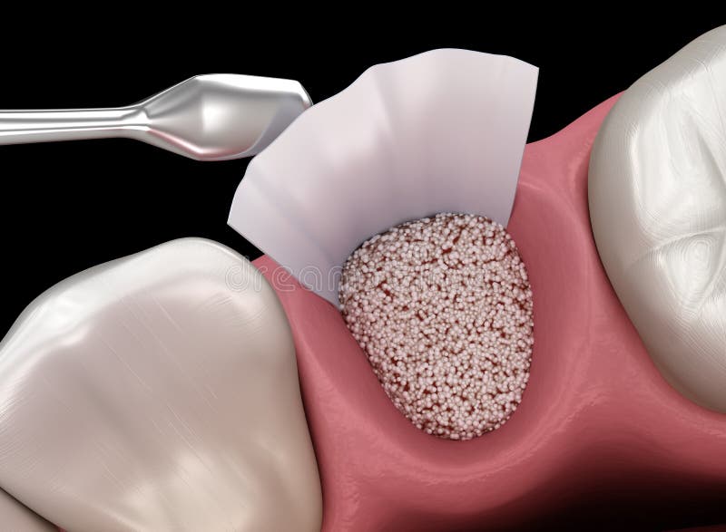 Augmentation Surgery - Adding Bone after Tooth Extraction. 3D ...