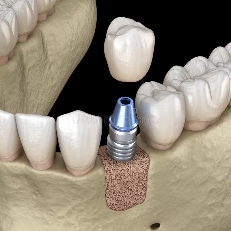 Augmentation Surgery - Adding New Bone. 3D Illustration Stock ...
