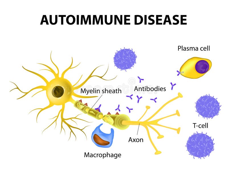Auto-immune Ziekte De Mechanismen Van Neuronenschade in Multipl Vector ...